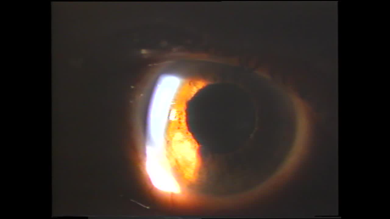 Iris Cysts Removal | Volume 32, Issue 4 - Video Journal of Cataract ...