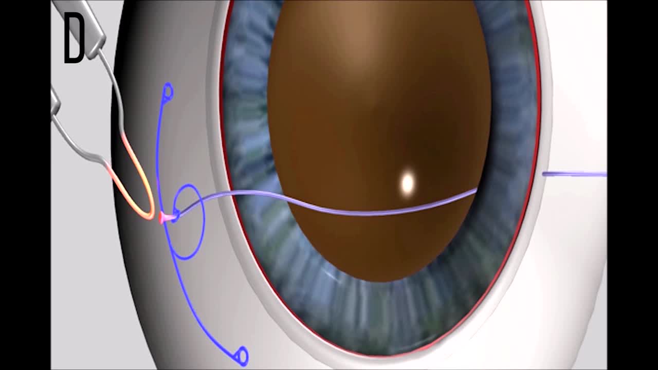 CTR Injector | Volume 35, Issue 1 - Video Journal of Cataract ...