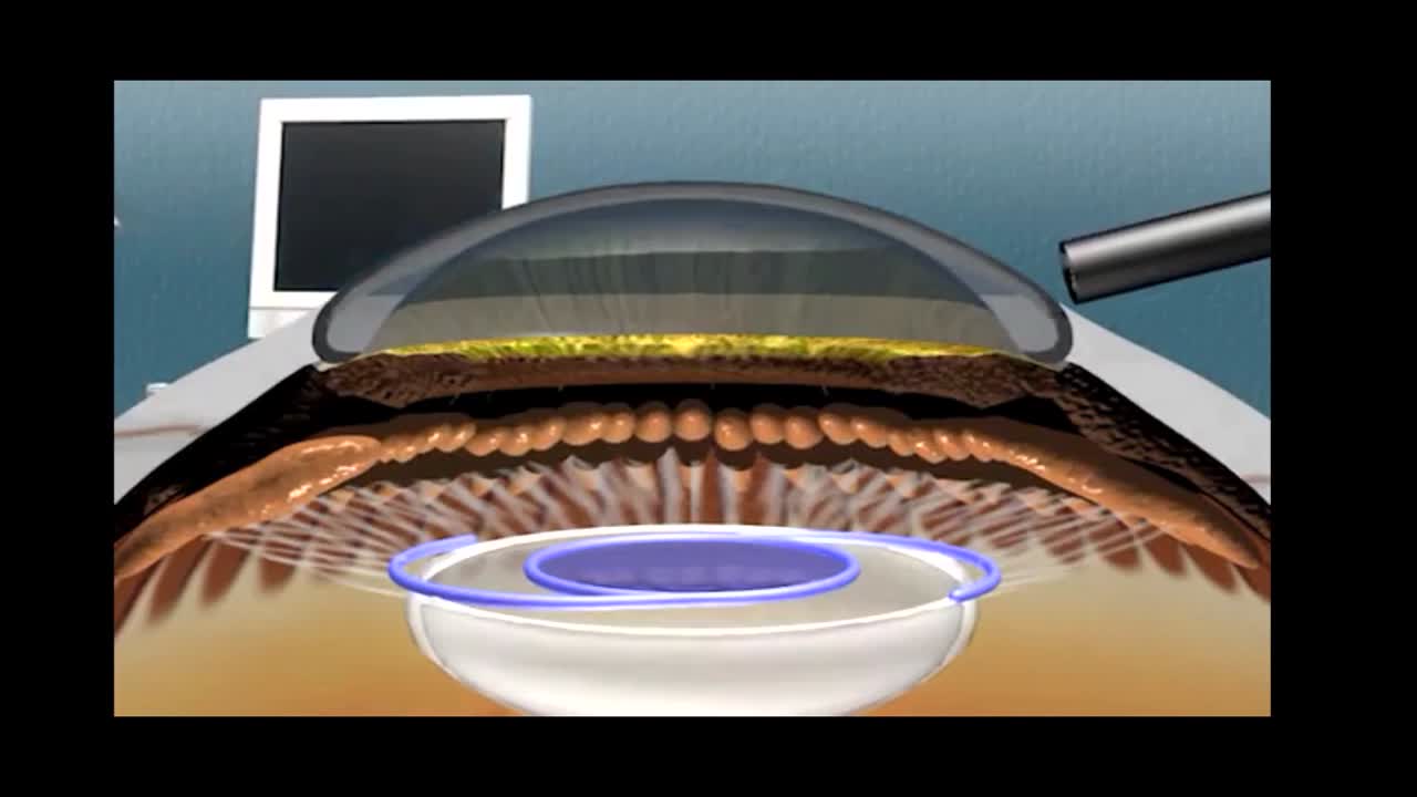 PreserFlo Micro Shunt | Volume 36, Issue 1 - Video Journal of Cataract ...