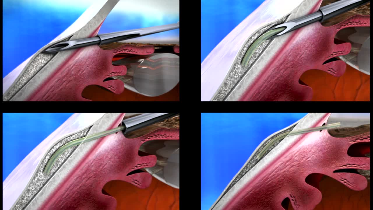 PreserFlo Micro Shunt | Volume 36, Issue 1 - Video Journal of Cataract ...